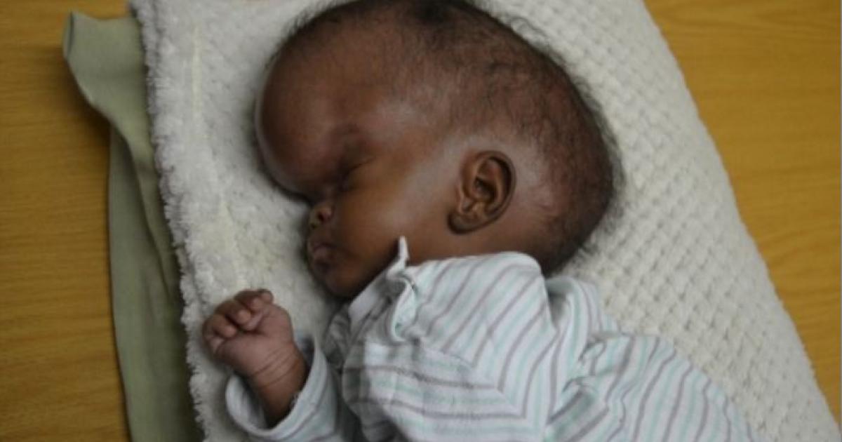 The story of a baby born with the hydrocephalic condition | nbc